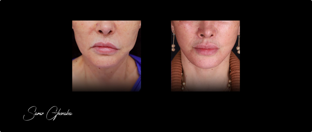 Chin bone augmentation - DR. SAMIR GHORABA