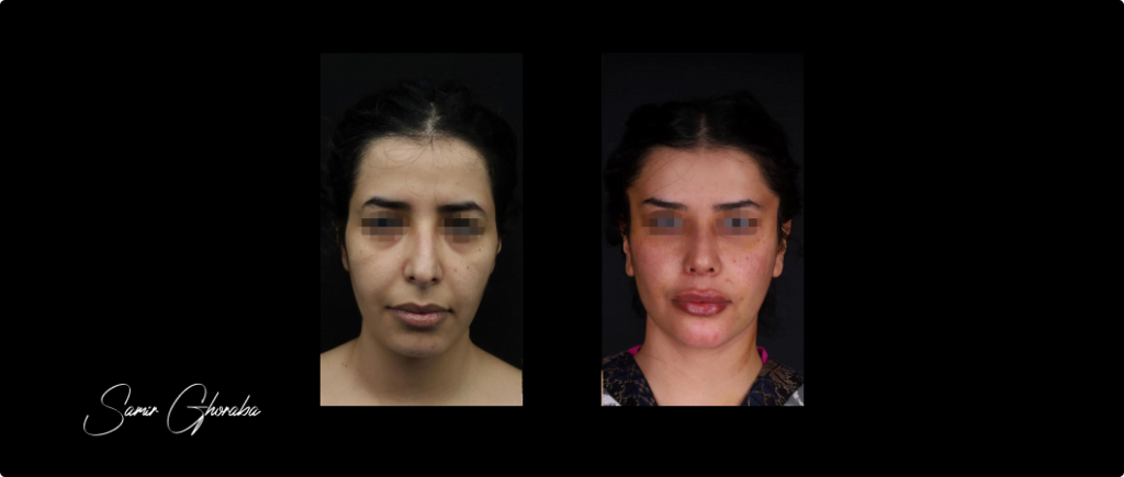Facial Makeover (Barbie Makeover) - DR. SAMIR GHORABA